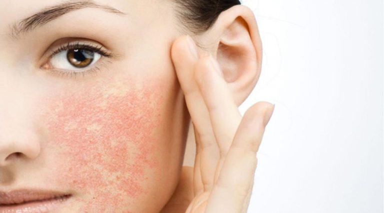 Understanding Persistent Skin Redness: Causes and Management – Fonexcode Understanding Persistent Skin Redness: Causes and Management – Fonexcode